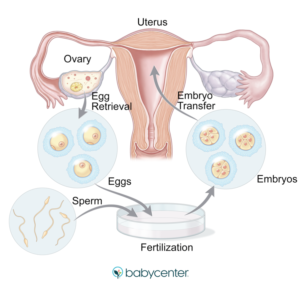 IVF چیست ؟ این روش درمان ناباروری با لقاح مصنوعی را بیشتر بشناسید - روزیاتو